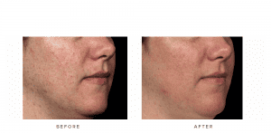 Fraxel Laser | Infinity Skin Clinic Mosman & Surry Hills, Sydney