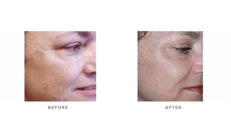 Fraxel Laser | Infinity Skin Clinic Mosman & Surry Hills, Sydney
