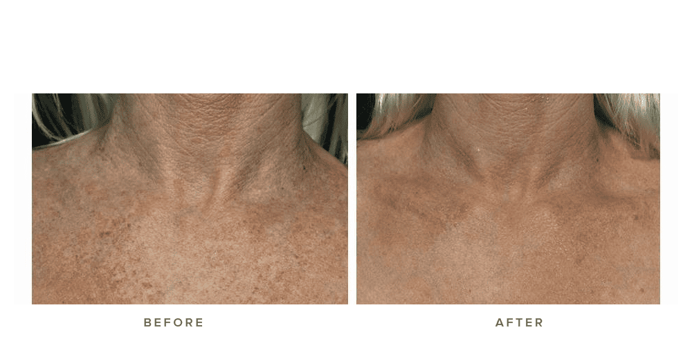 Fraxel Laser | Infinity Skin Clinic Mosman & Surry Hills, Sydney