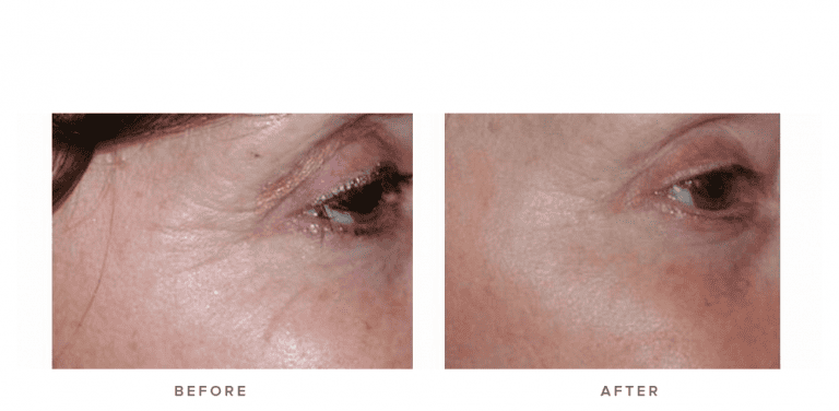 Fraxel Laser | Infinity Skin Clinic Mosman & Surry Hills, Sydney