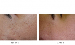 Laser Genesis Before and After Images | Infinity Skin Clinic
