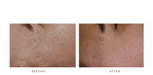 Laser Genesis Sydney | Laser Resurfacing | Infinity Skin Clinic