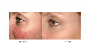 Laser Genesis Sydney | Laser Resurfacing | Infinity Skin Clinic
