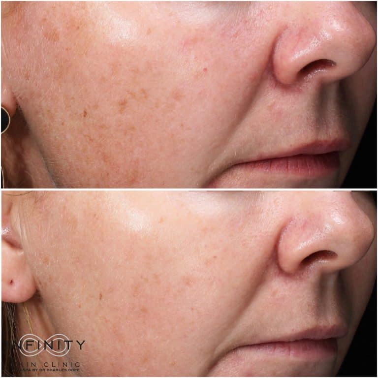 SkinPen Microneedling Before and After Images | Infinity
