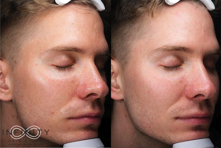 SkinPen Microneedling Before and After Images | Infinity