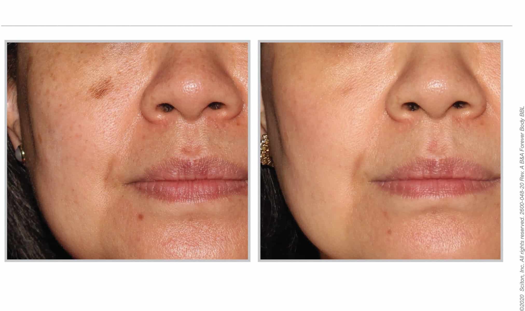 BBL Hero Treatment Sydney | Infinity Skin Clinic