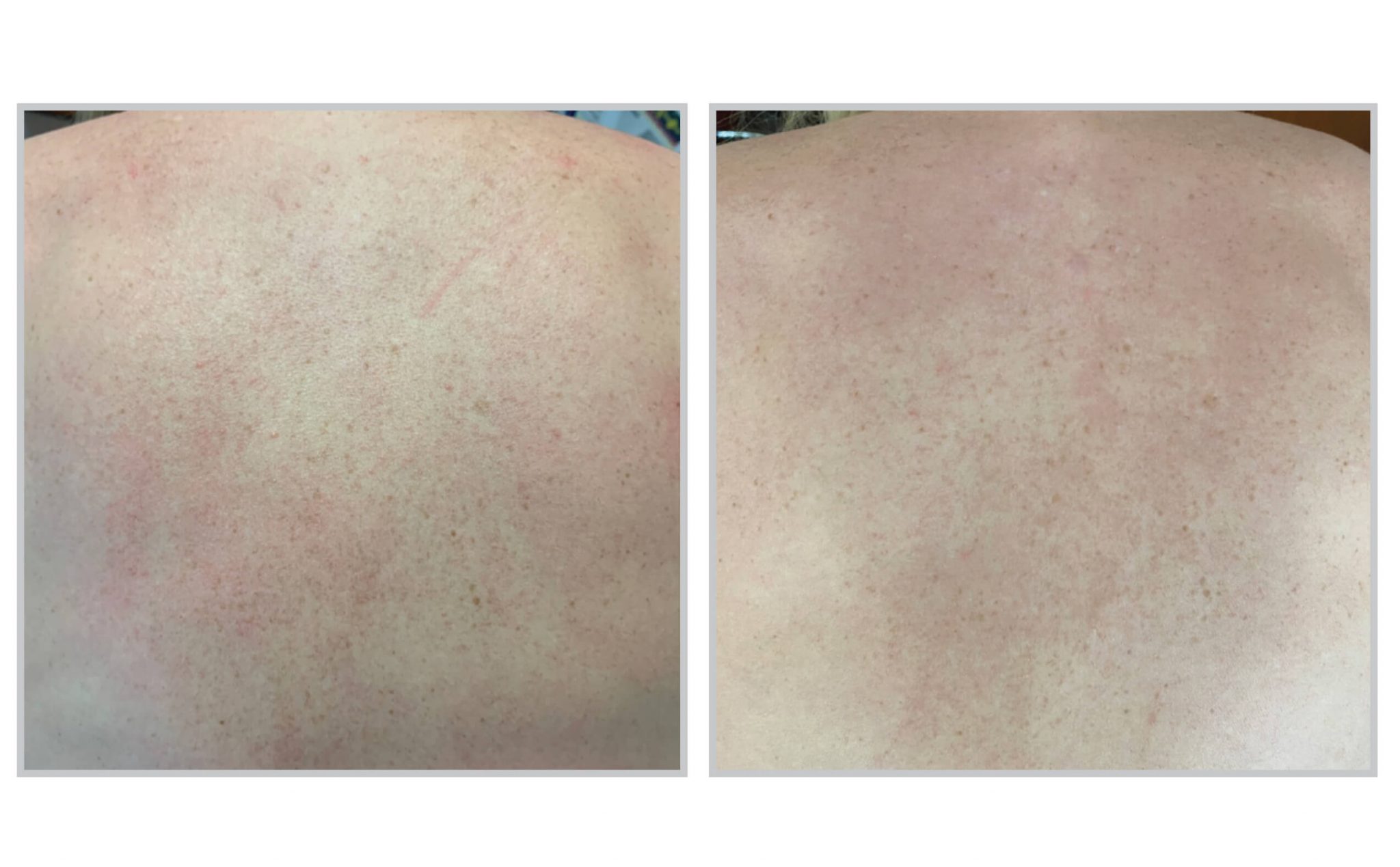 BBL Hero Treatment Sydney | Infinity Skin Clinic