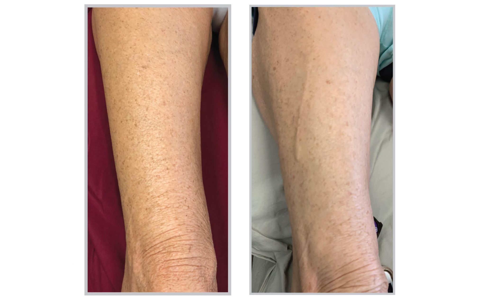 BBL Hero Treatment Sydney | Infinity Skin Clinic