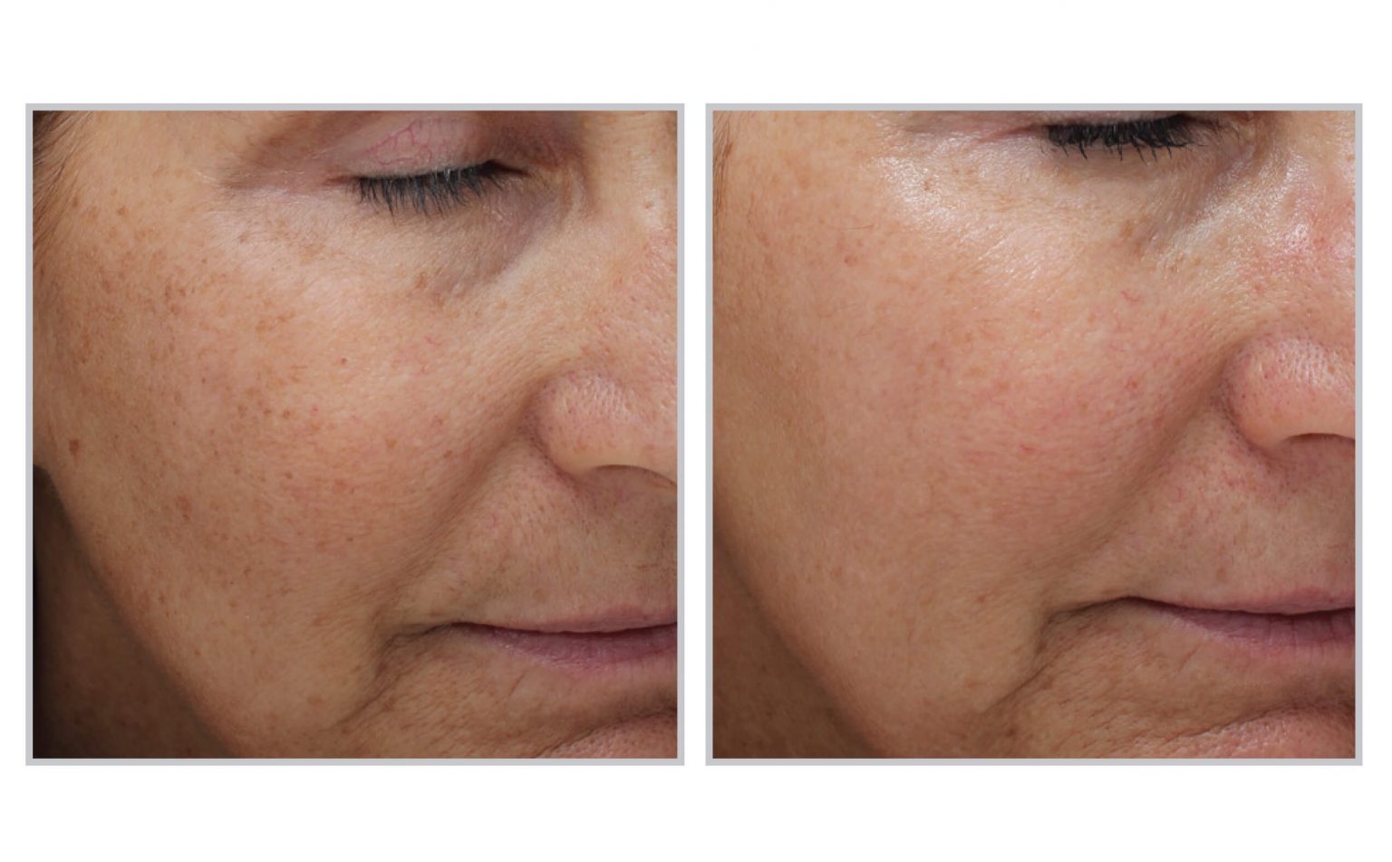 moxi-laser-sydney-infinity-skin-clinic