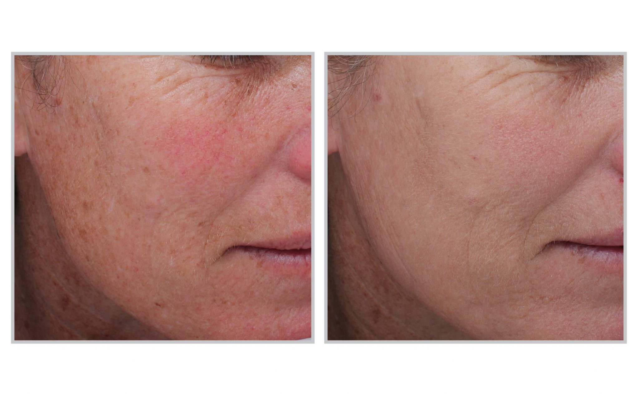 Moxi Laser Sydney | Infinity Skin Clinic