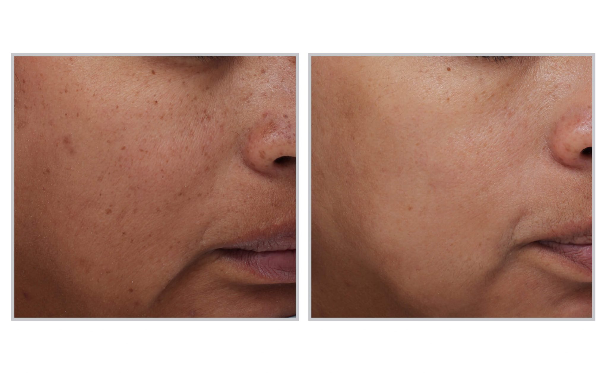 Moxi Laser Sydney | Infinity Skin Clinic