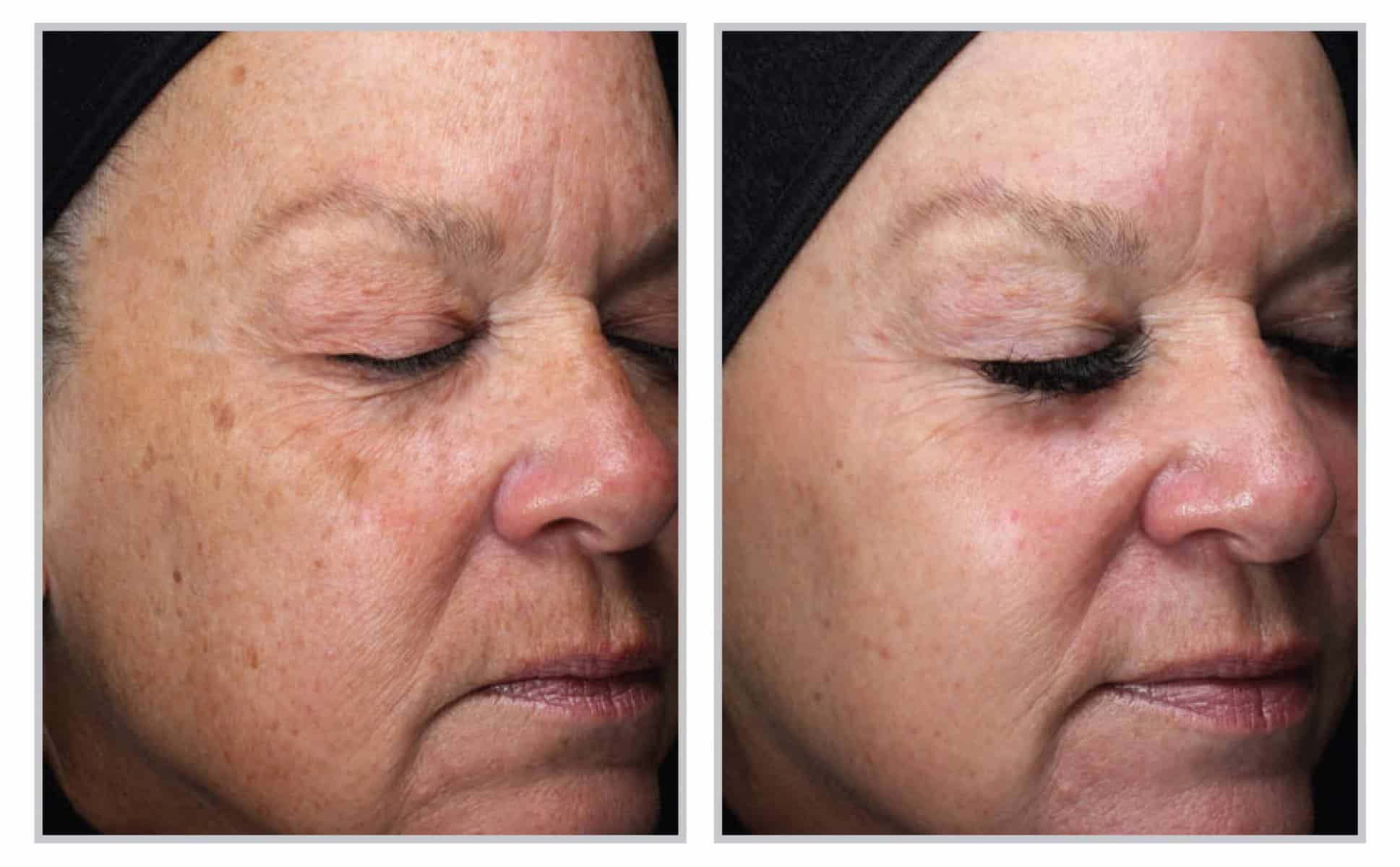 SkinTyte™ Laser Treatment Sydney | Infinity Skin Clinic