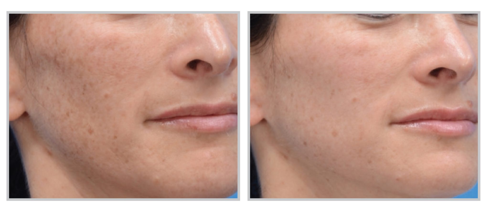 Moxi Laser Sydney | Infinity Skin Clinic